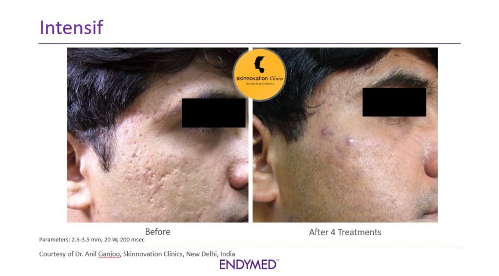 How To Effectively Treat Acne Scars - ENDYMED