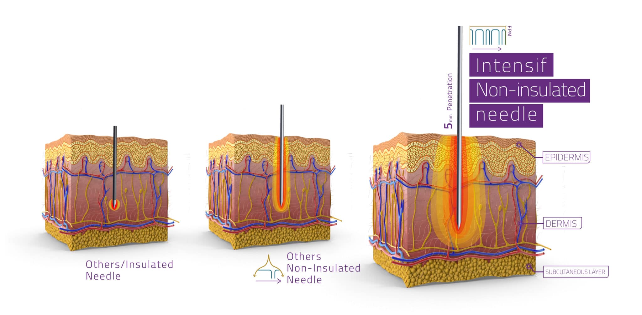 Intensif Applicator - ENDYMED