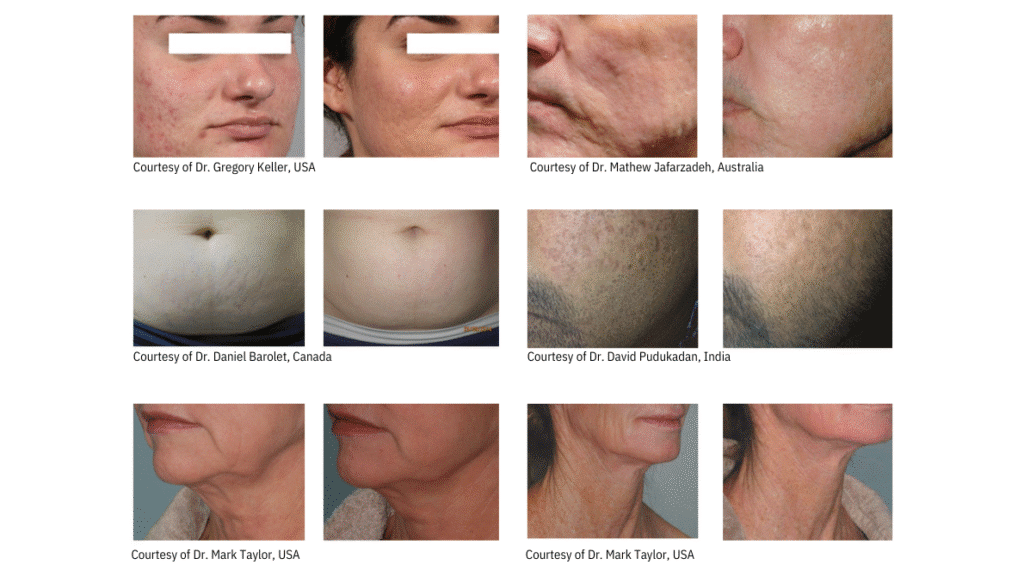 The Ultimate Microneedling Experience: EndyMed’s RF